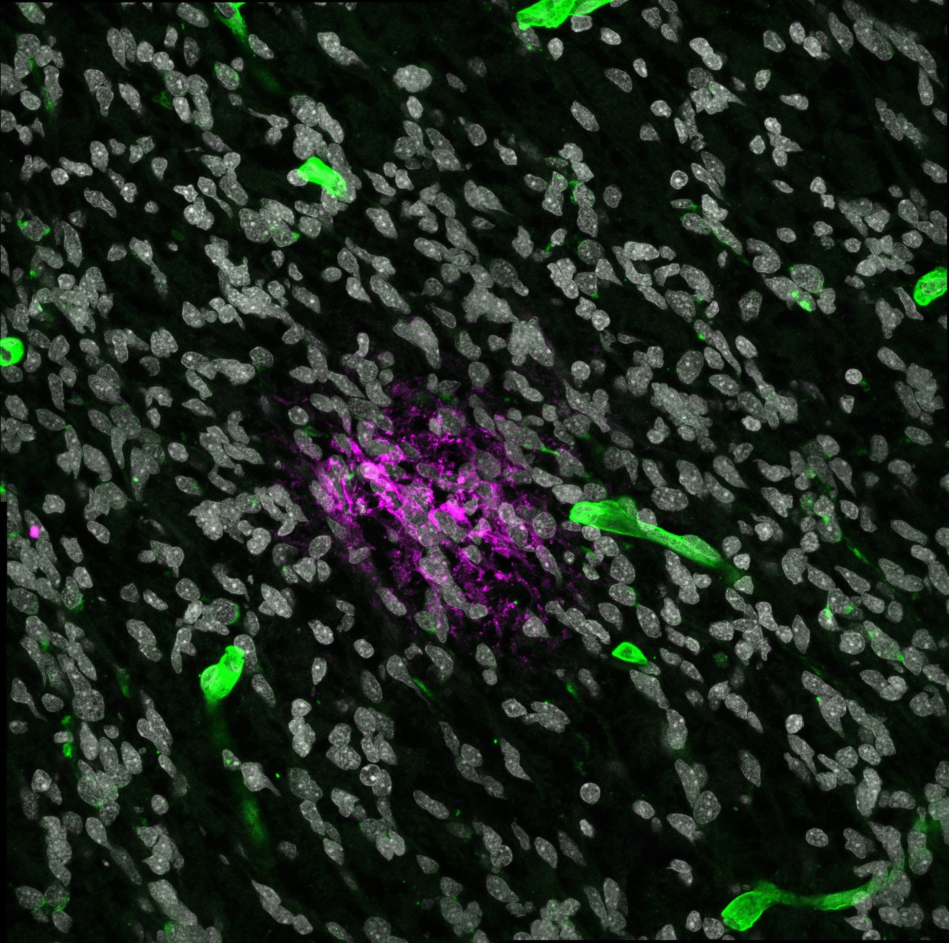 Haemorrhages in foetal brain tissue associated with the presence of ...